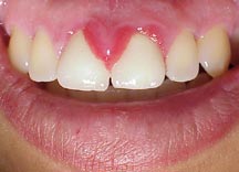 Epulis Gum 5: Gingival Enlargements – Localised | Pocket Dentistry